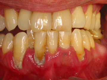 Apical Periodontitis: Symptoms and Treatment | Intelligent Dental