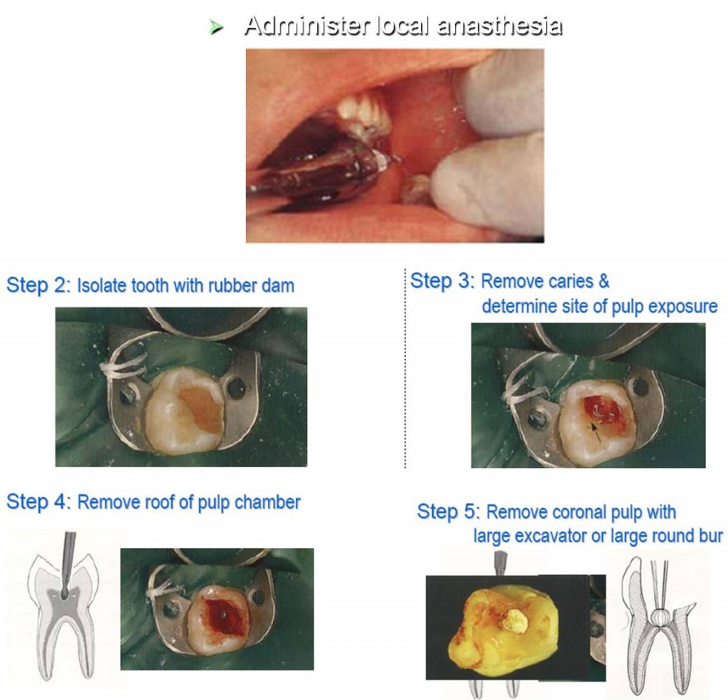 Pulpotomy, Apexogenesis and Apexification Part 1 | Intelligent Dental
