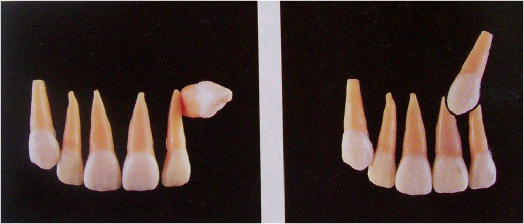 Impacted Teeth Part 2 | Intelligent Dental